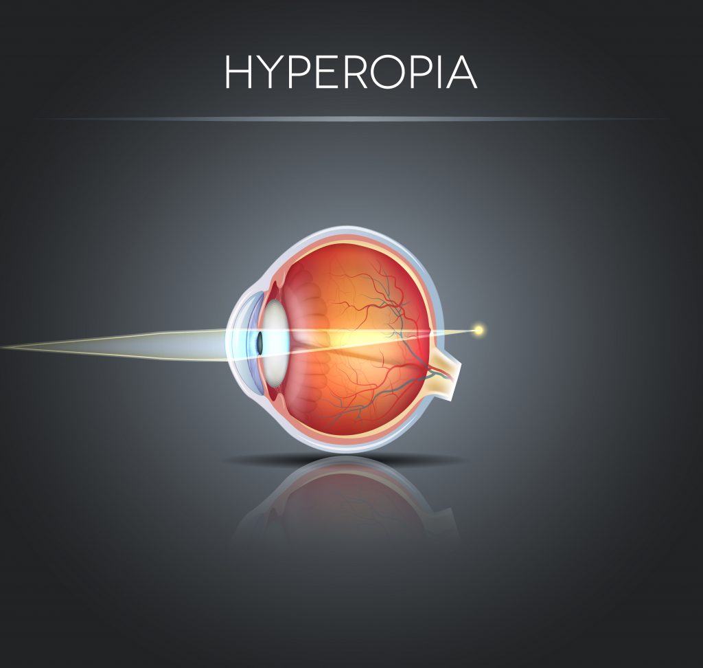 Hyperopia, vision disorder | Moran Eye Associates