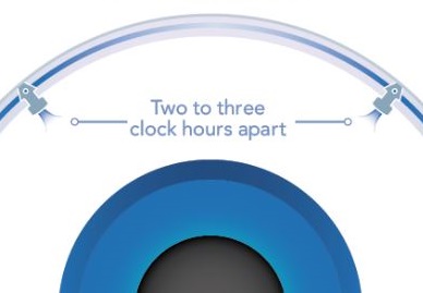 Treating Cataracts & Glaucoma Together with the iStent | Moran Eye ...