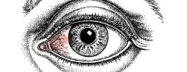 Surfer's Eye - Moran Eye Associates